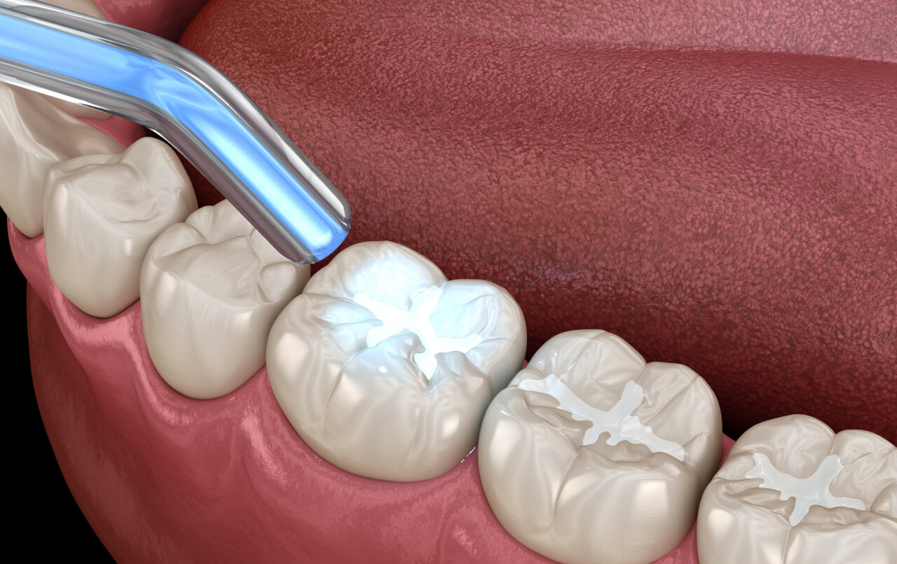 What Happens When You Get a Dental Filling ? Everything You Need To ...